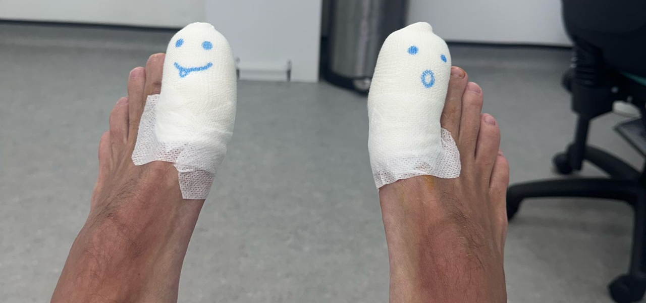 Expert Tips for Treating Ingrown Toenails - Surrey Foot Service Ltd